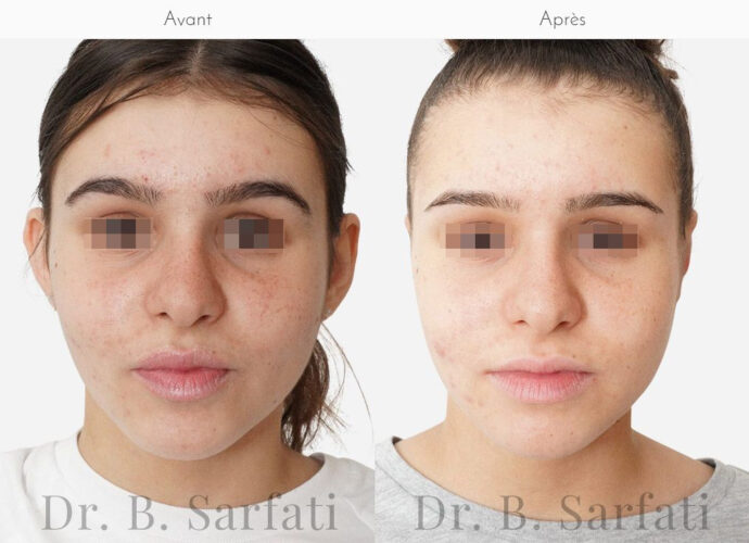 Quand envisager une otoplastie pour corriger des oreilles décollées ...