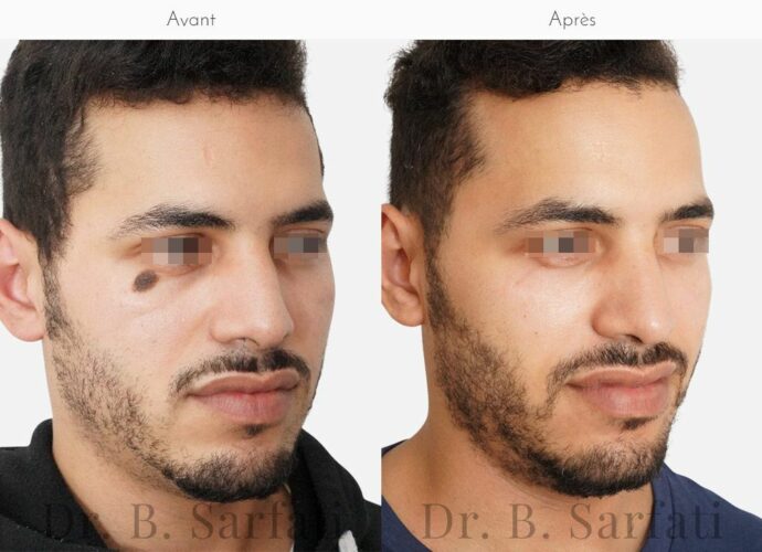 Cancers de la peau (carcinome basocellullaire) | Paris | Dr B. Sarfati